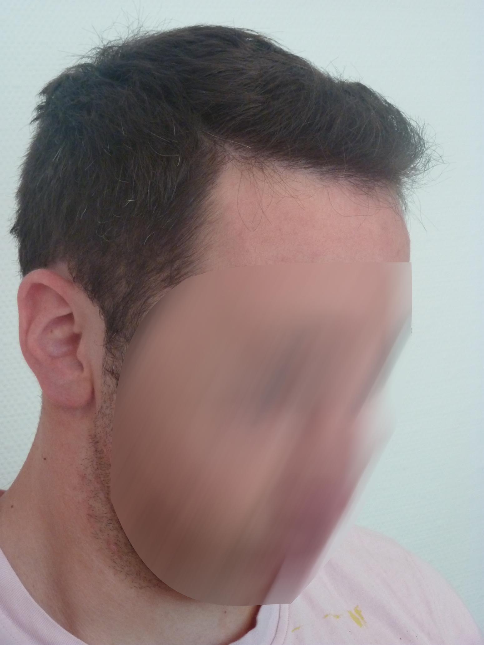 Ligne frontale par le Dr Mwamba avec 1500 FIT - Greffe-cheveux