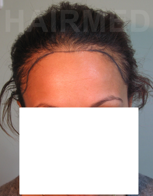 avant_abaissement_ligne_frontale_feminine - Greffe-cheveux